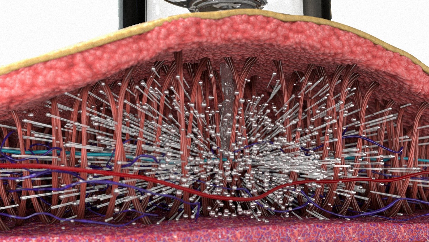 EnerJet: Revolutionising Scar Treatment - Sinclair Global
