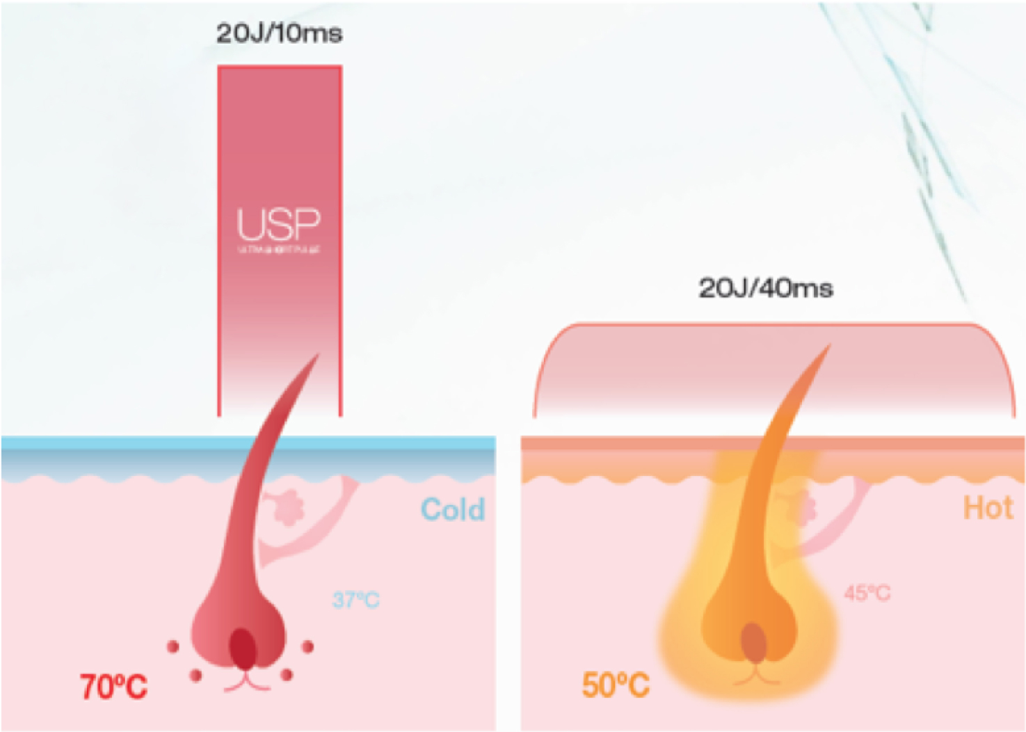 Primelase Laser Hair Removal - Sinclair Global