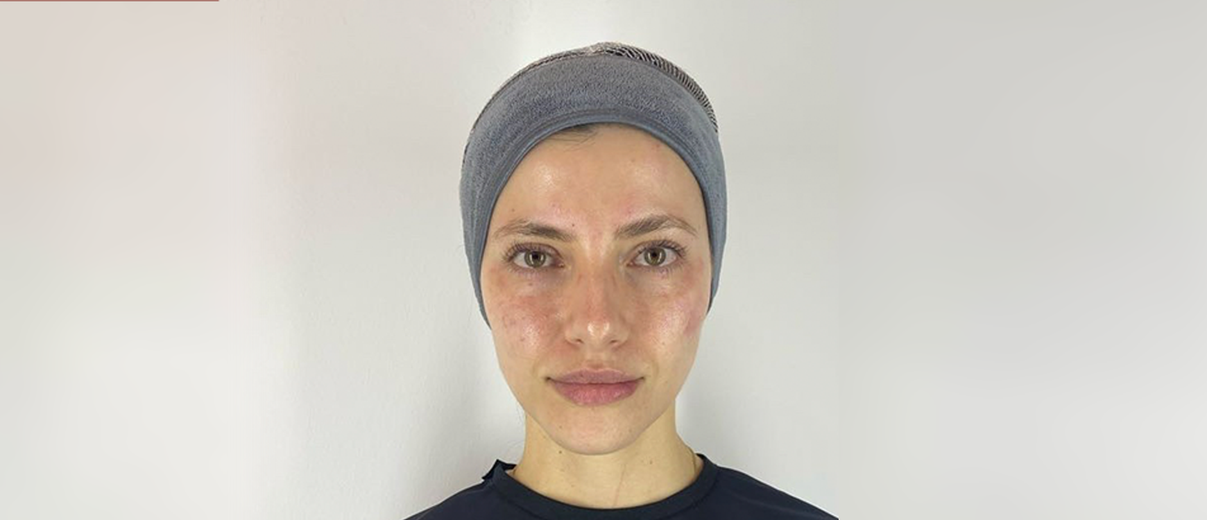 Premium Hyaluronic Acid (HA) Dermal Fillers | MaiLi - Sinclair Global