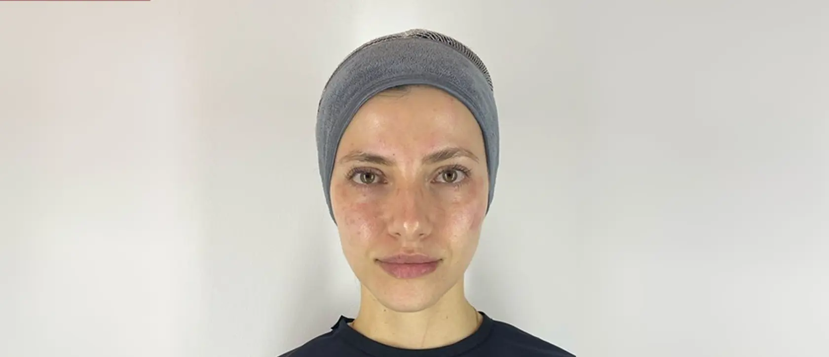 Premium Hyaluronic Acid (HA) Dermal Fillers | MaiLi - Sinclair Global