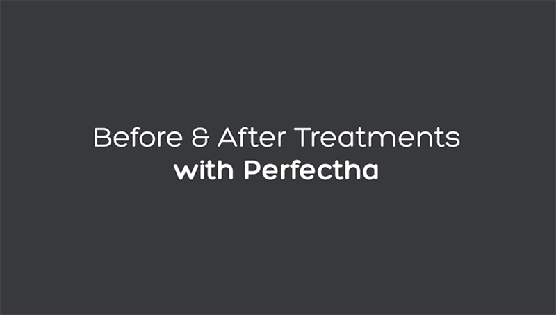 Perfectha Hyaluronic Acid Dermal Fillers | Perfectha® - Sinclair United ...